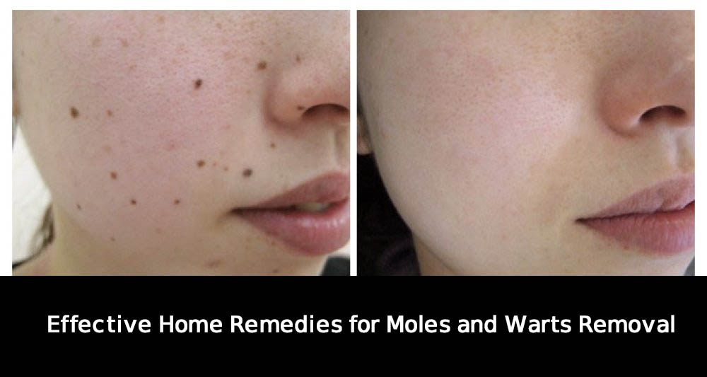 Effective Home Remedies for Moles and Warts Removal - ThePakistanToday